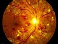 Hypertensive Retinopathy | Patterson Optical, P.A.